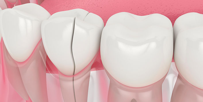 Types of Dental Root Fractures Peabody, MA | Northside Dental Care, PC ...